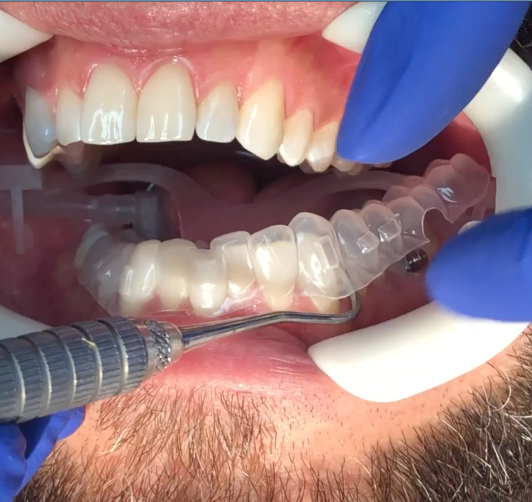 Ormco - Spark™ - Innovative & Advanced Clear Aligner System