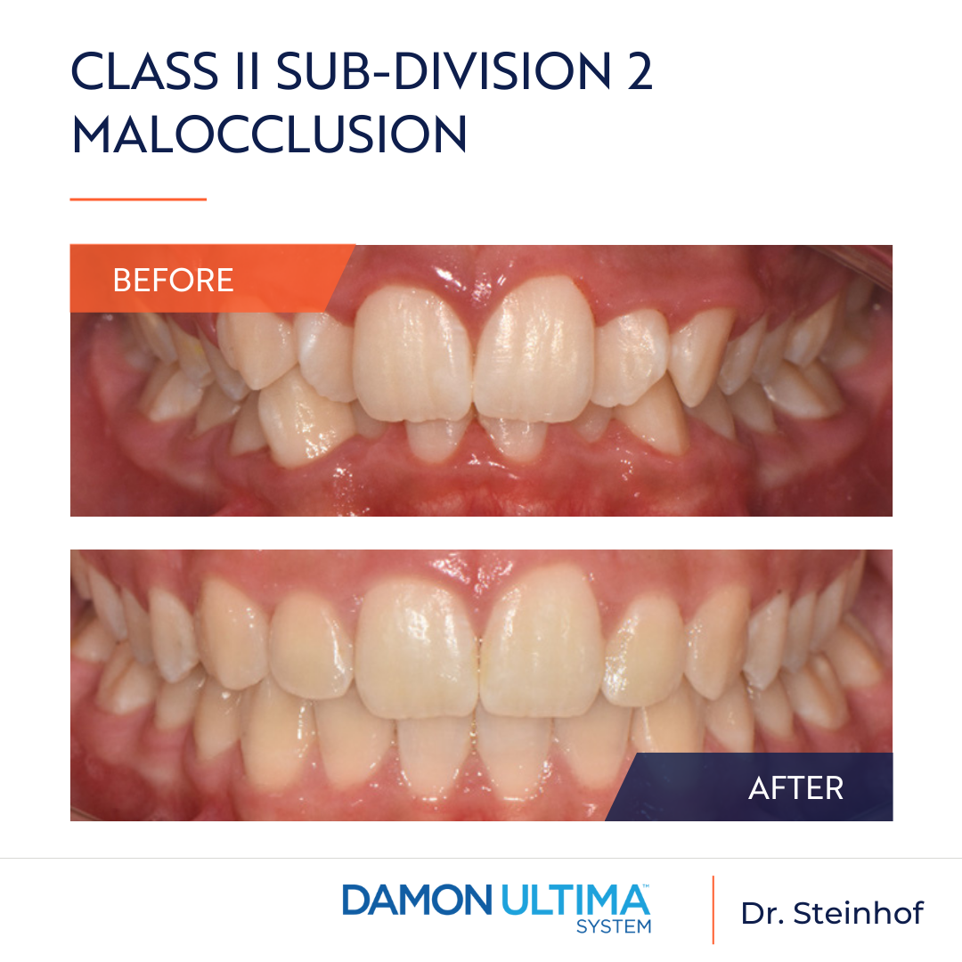 Class II sub-division 2 malocclusion with significant maxillary and ...