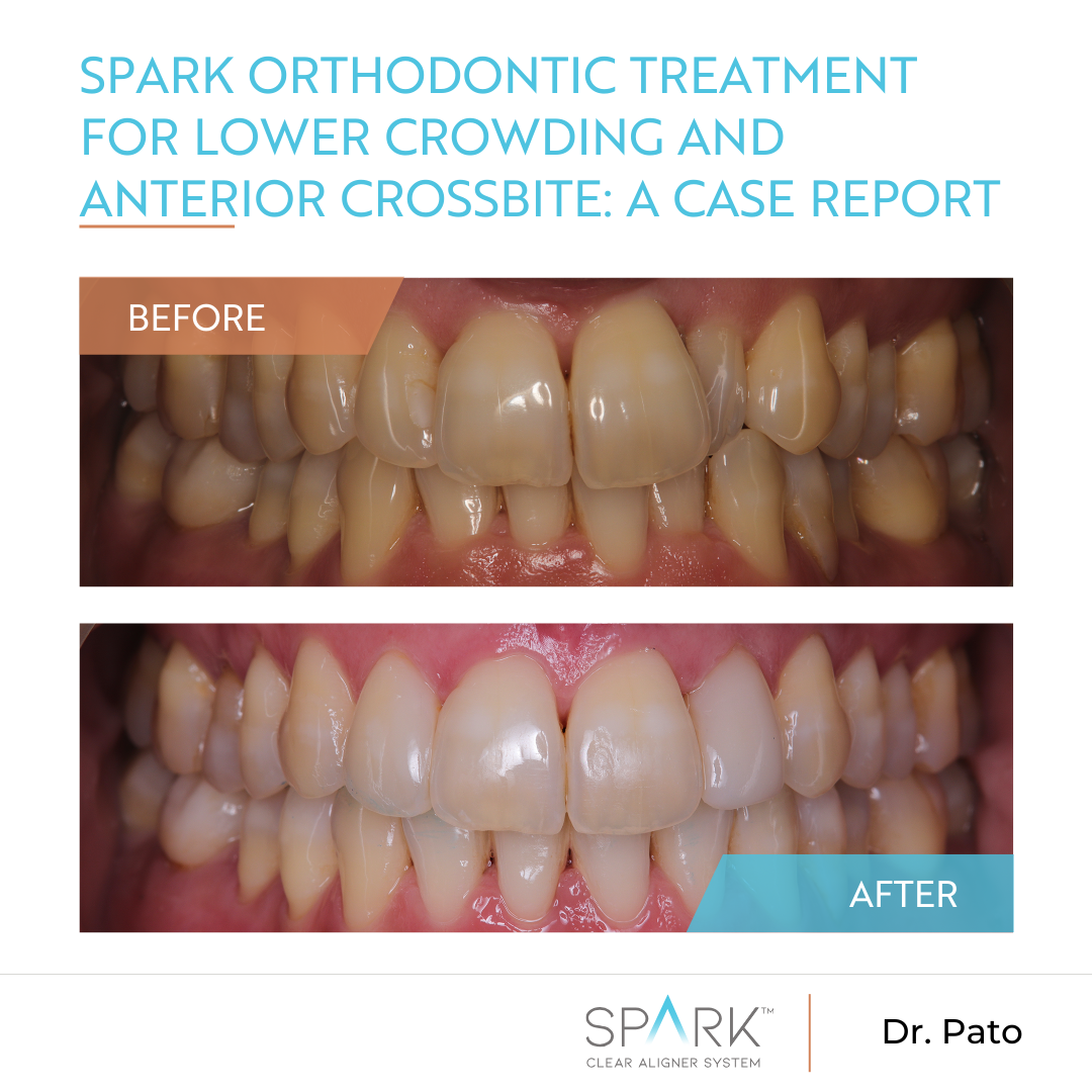 Spark orthodontic treatment for lower crowding and anterior crossbite ...